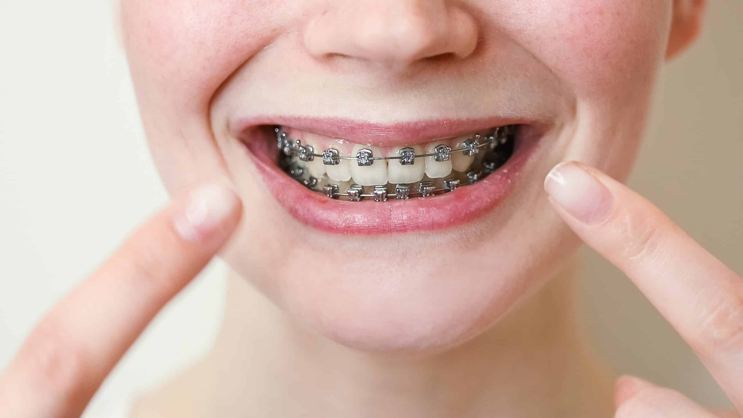 Traditional Braces in West Jordan & Draper | Zurcher Orthodontics